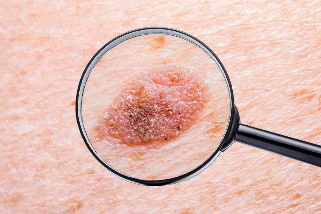 What to Watch Out For – Early Signs of Skin Cancer
