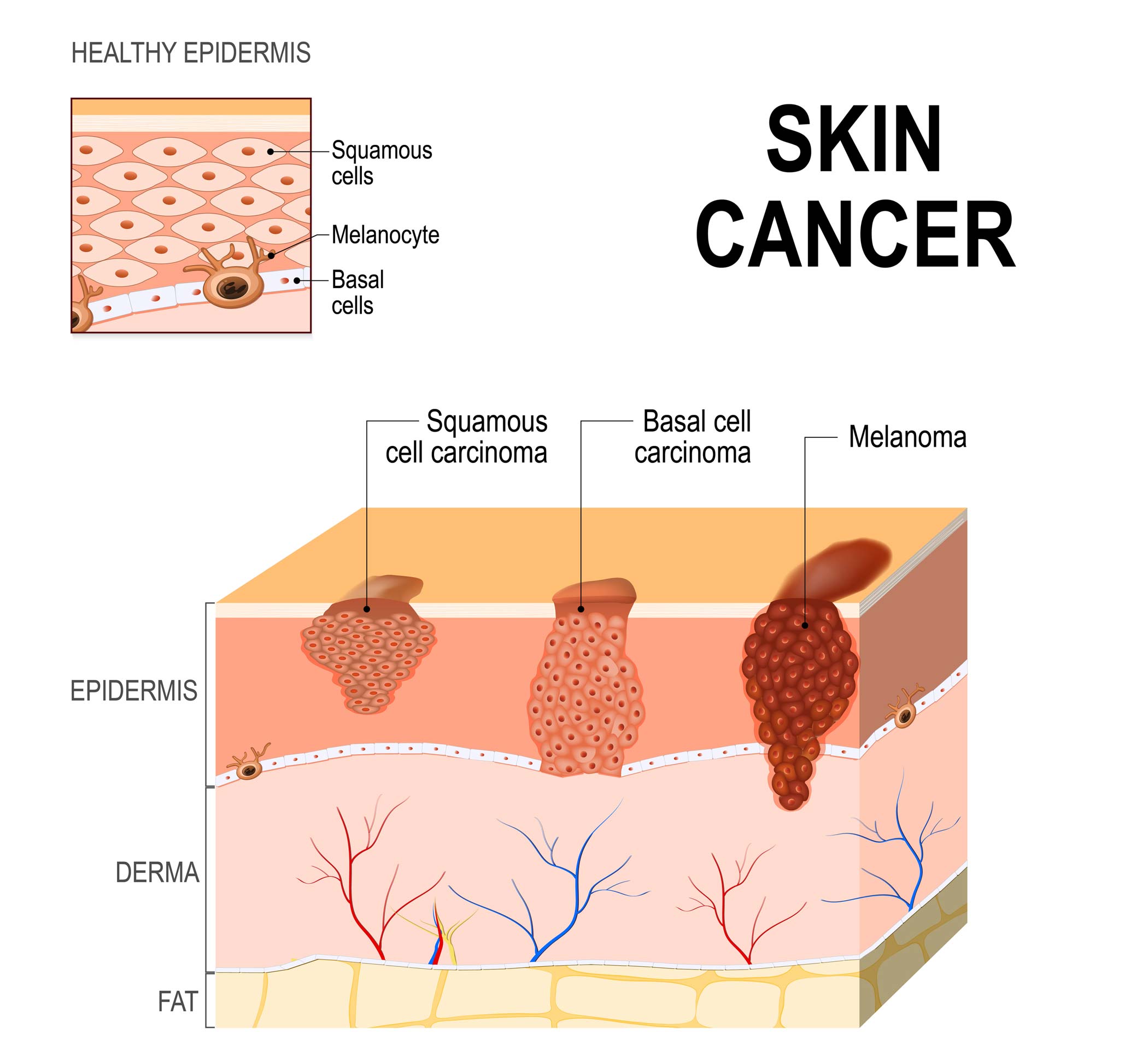 What To Watch Out For Early Signs Of Skin Cancer